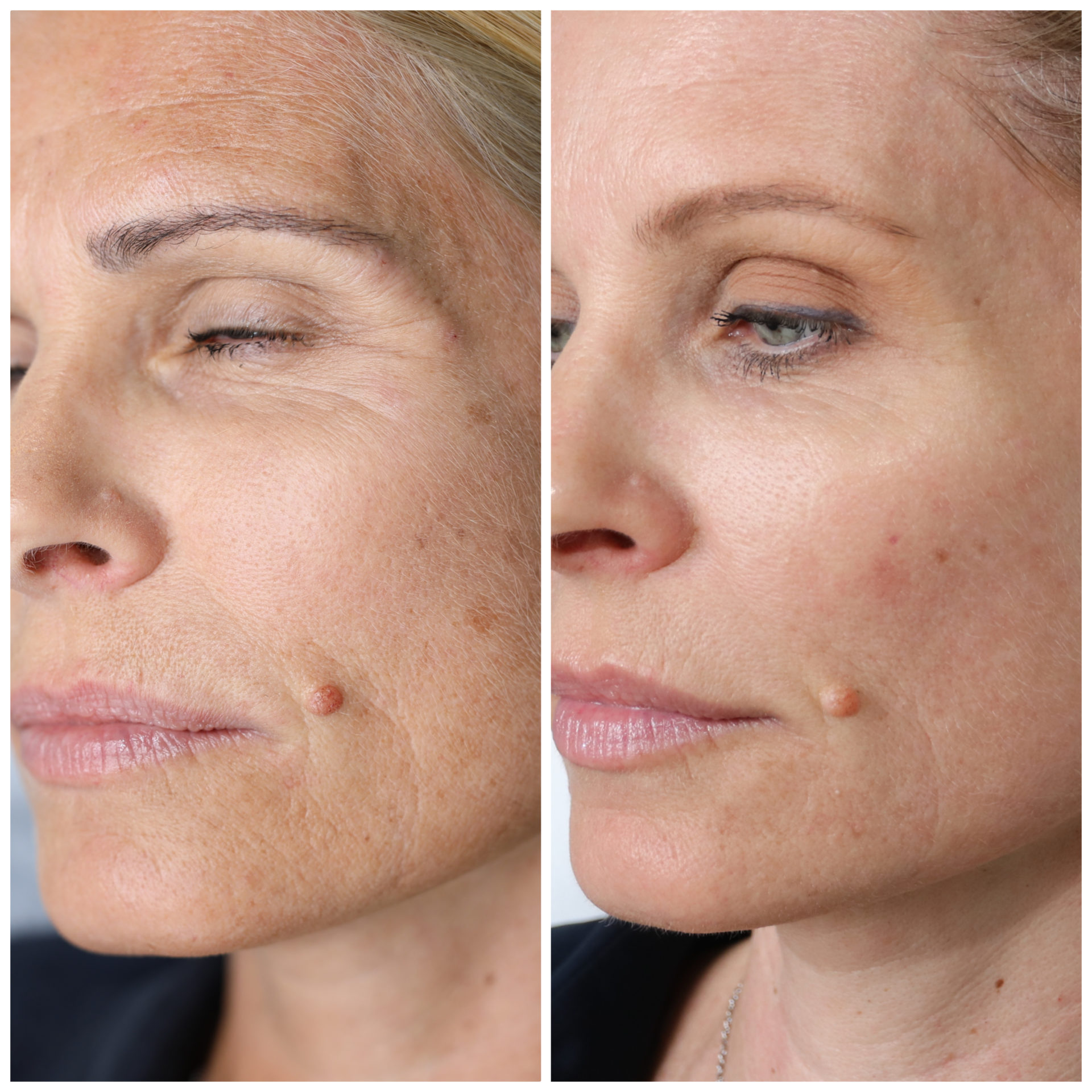 IPL - Skin Rejuvenation - Svenska Hudkliniker