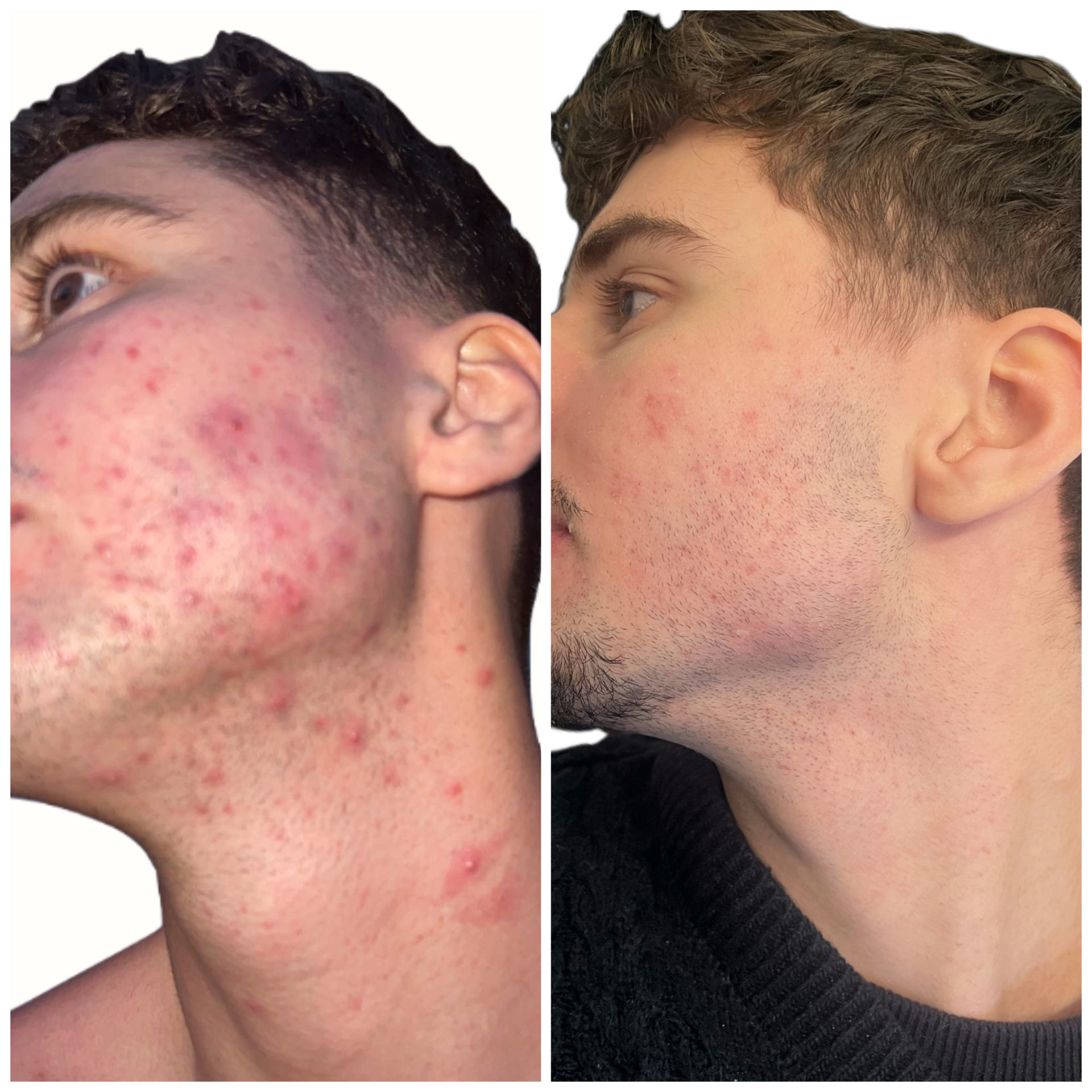 Fotona - Aktiv Akne - Svenska Hudkliniker