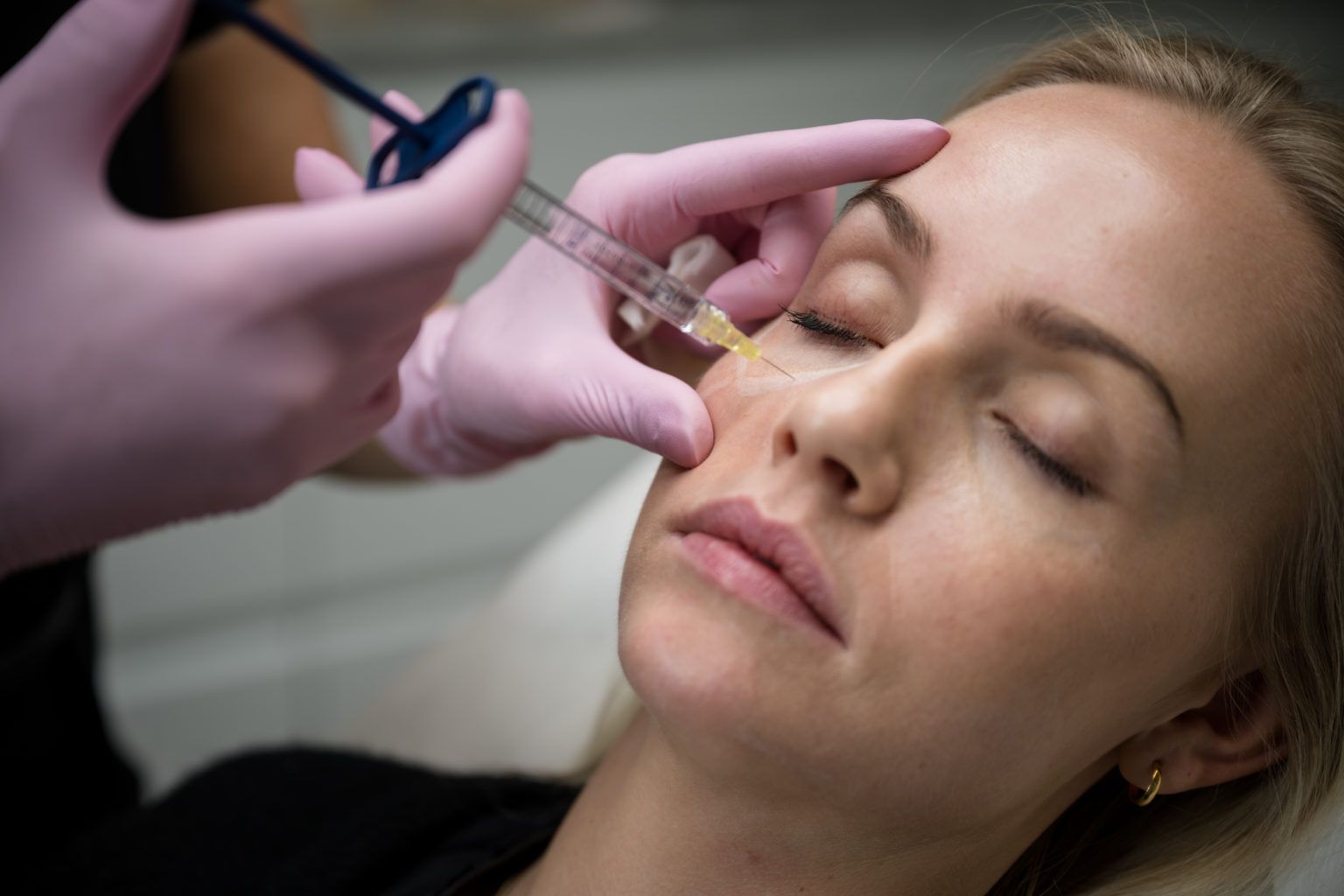 Fillers - Svenska Hudkliniker