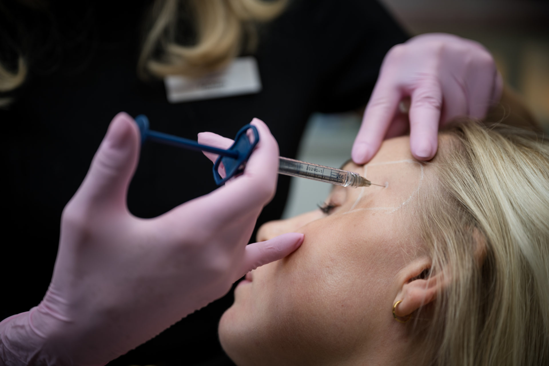 Fillers - Svenska Hudkliniker