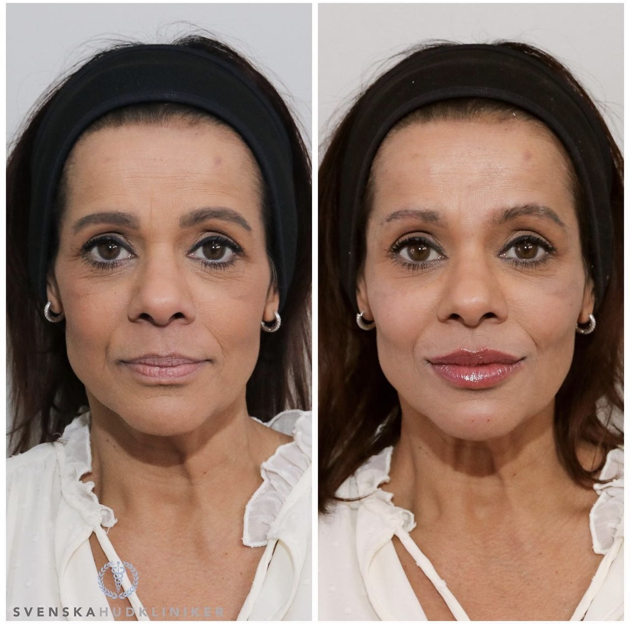 Softlift - Kvinna - Svenska Hudkliniker